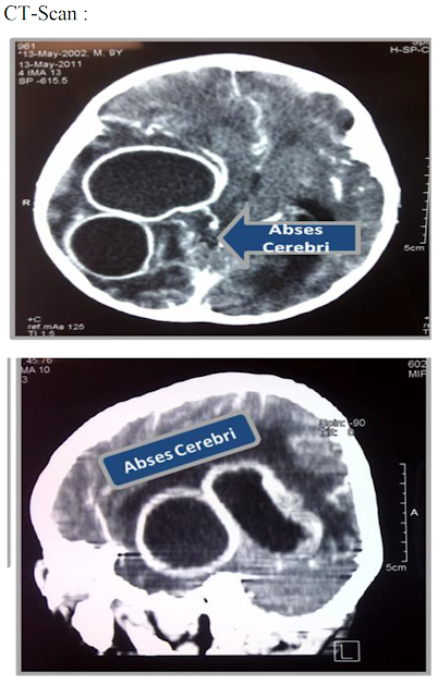 PENATALAKSANAAN ANESTESI UNTUK DRAINASE ABSES OTAK PASIEN DENGAN ...