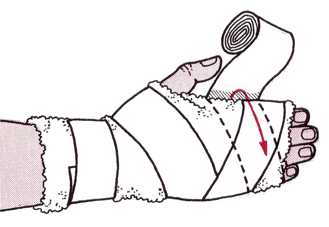 crescentsmexcel: Jenis-Jenis Balutan Luka