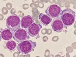 ♥Generalidades de las Leucemias♥: CLASIFICACIÓN DE LAS LEUCEMIAS