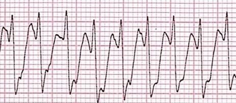 Cardiac Arrythmias and ECG Guidelines