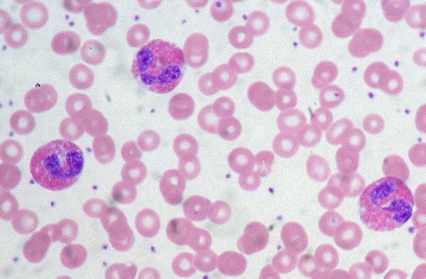 Eosinophils Blood Test Procedure Causes Of Eosinophilia