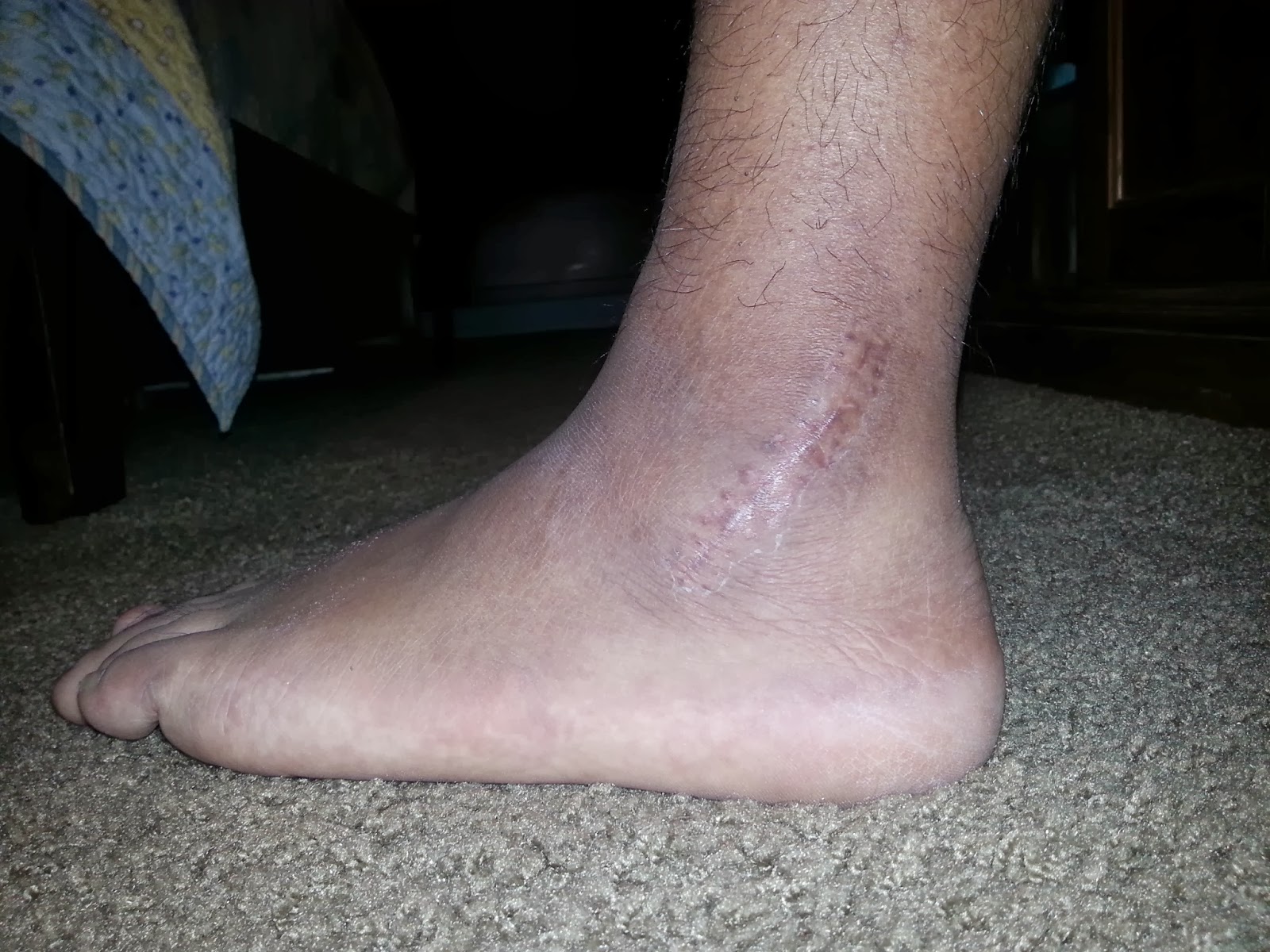 Peroneal Tendon Surgery Recovery: Ankle Time Line (updated for week 10/11)
