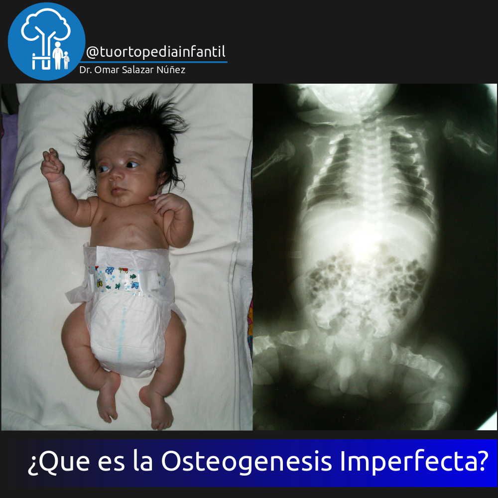 ¿Que es la Osteogenesis Imperfecta?