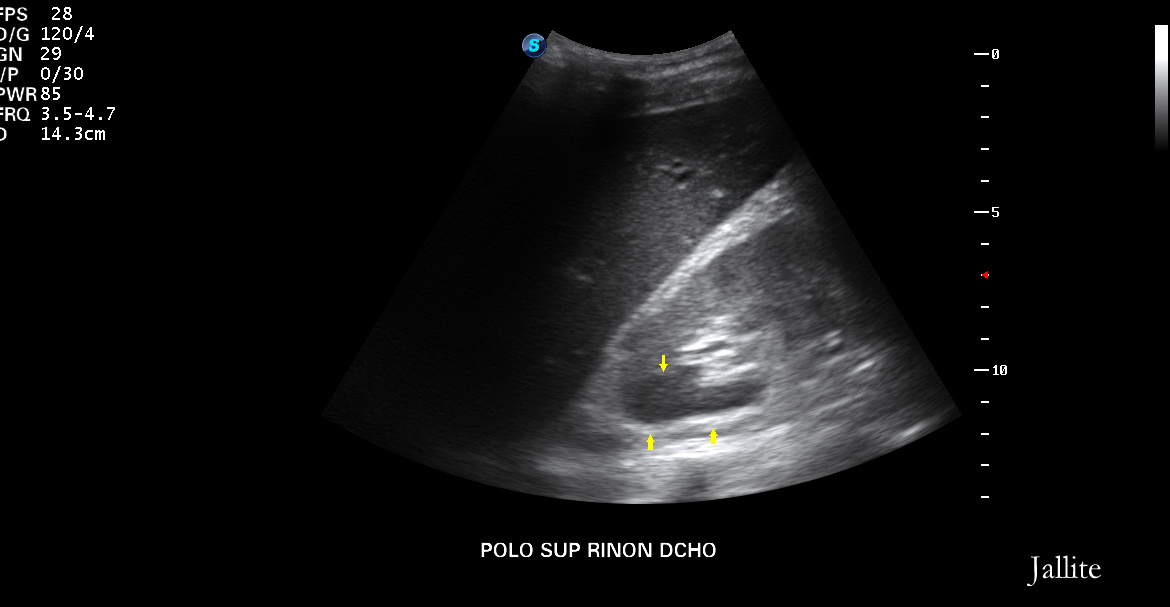 Absceso & Hidronefrosis Renal