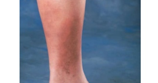 Insuficiencia venosa cronica