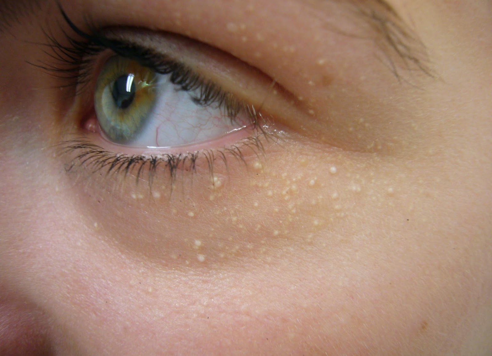 online biology classes: Milia on face