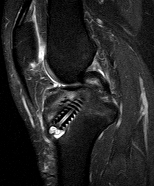 Anterior Cruciate ligament Reconstruction – what the Radiologist needs ...