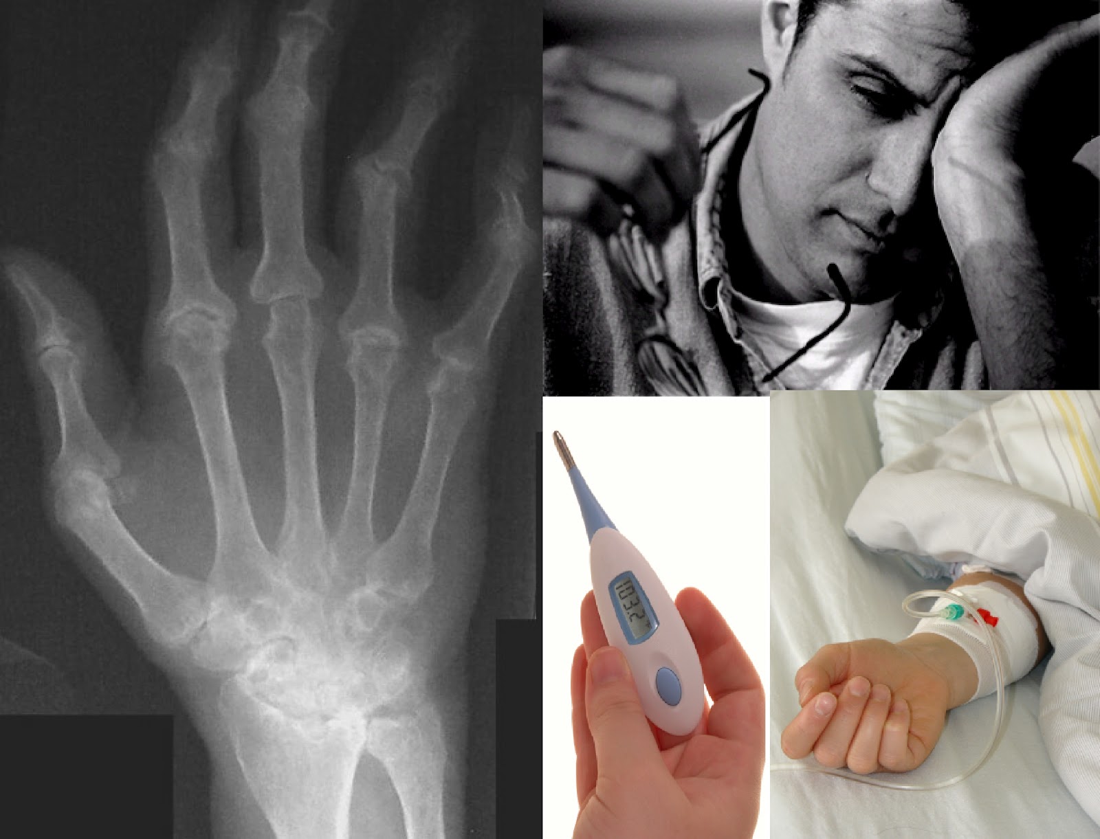 Autoimmune Arthritis = Autoimmune Disease + Arthritis.: Let's Tip the ...