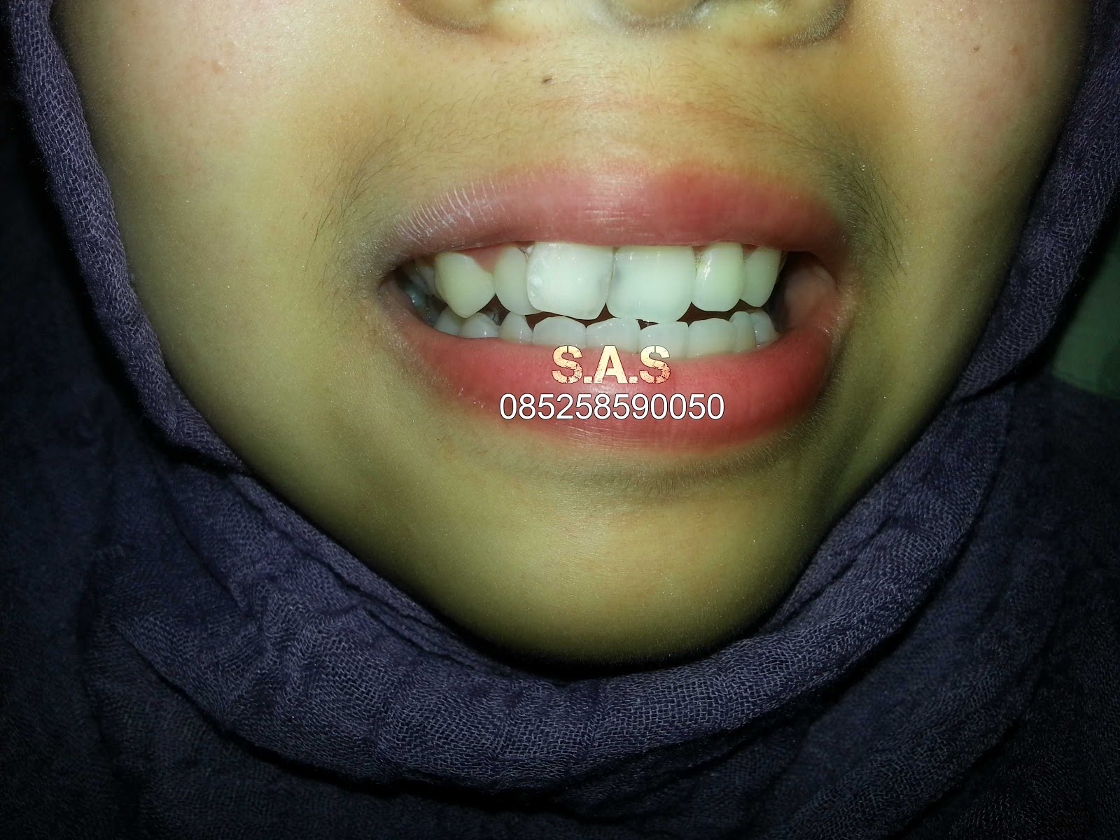 S.A.S - AHLI GIGI KOTA PATI, Jateng & KOTA JEMBER, Jatim: Cara Membuat ...