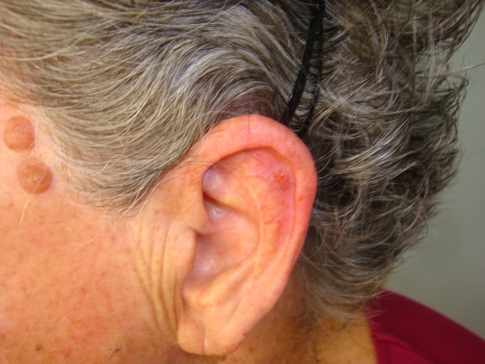 Dermpath Made Simple - Neoplastic: Benign Nevi