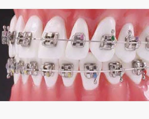 Martin Casale Ortodoncia Rápida e Invisible: Moda de brackets chimbos ...