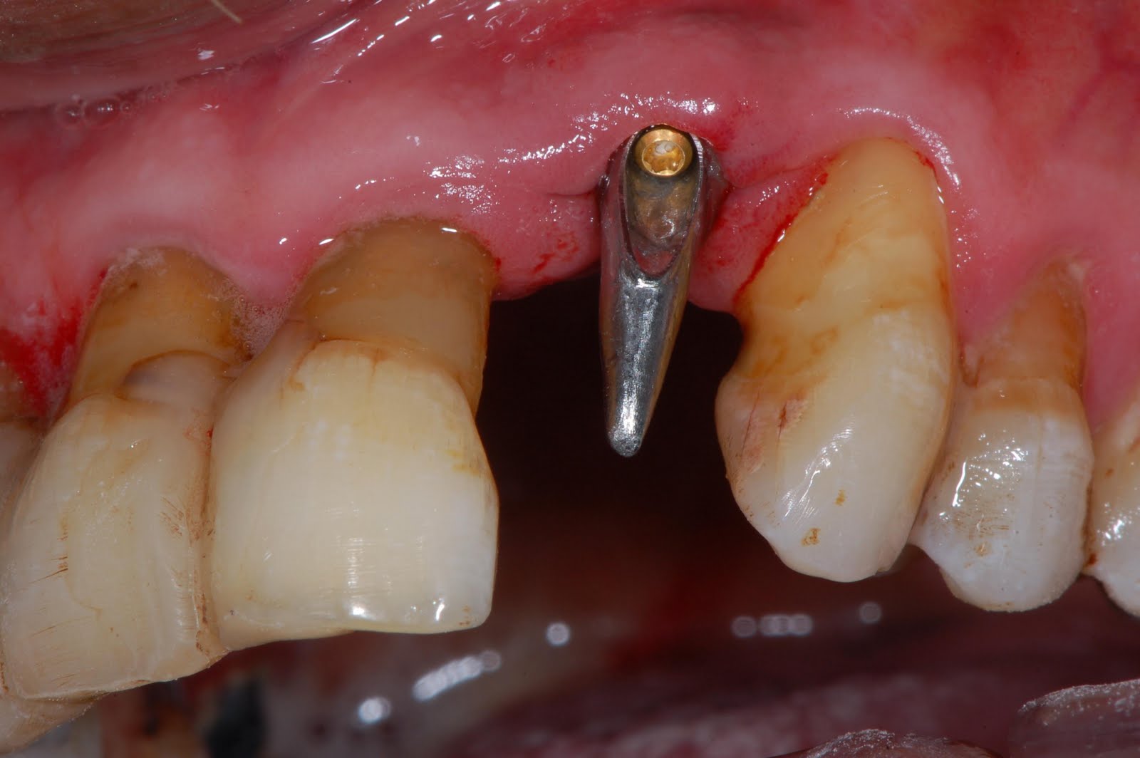 Docteur J.M. STROUMZA: Prothèse implanto portée dans le cadre d’une ...