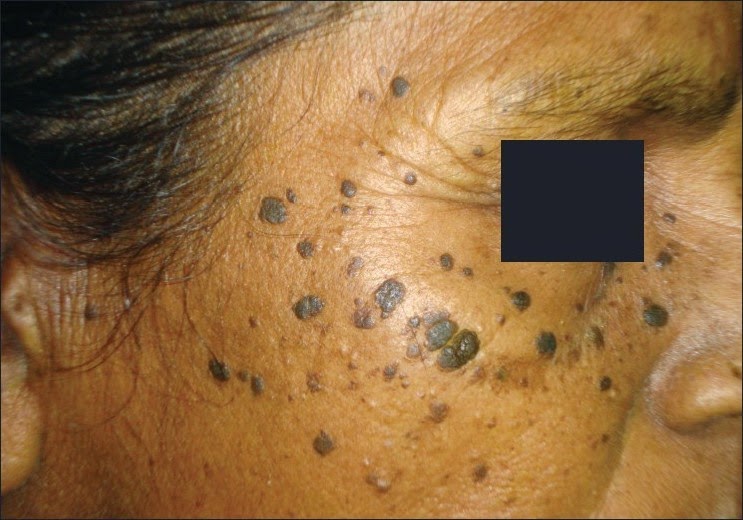 SKIN DISEASE TYPES: Seborrheic Keratosis (Skin Disease Type)