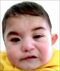 Medical Treatment Pictures-for Better Understanding: CHARGE Syndrome