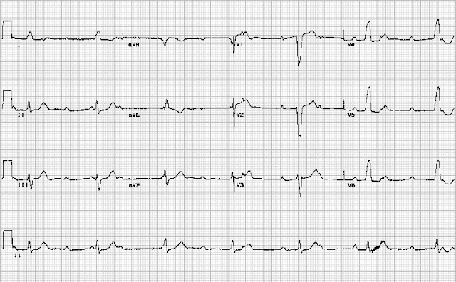 Belajar EKG cepat 20 menit Gratiss ~ BelajarEKG