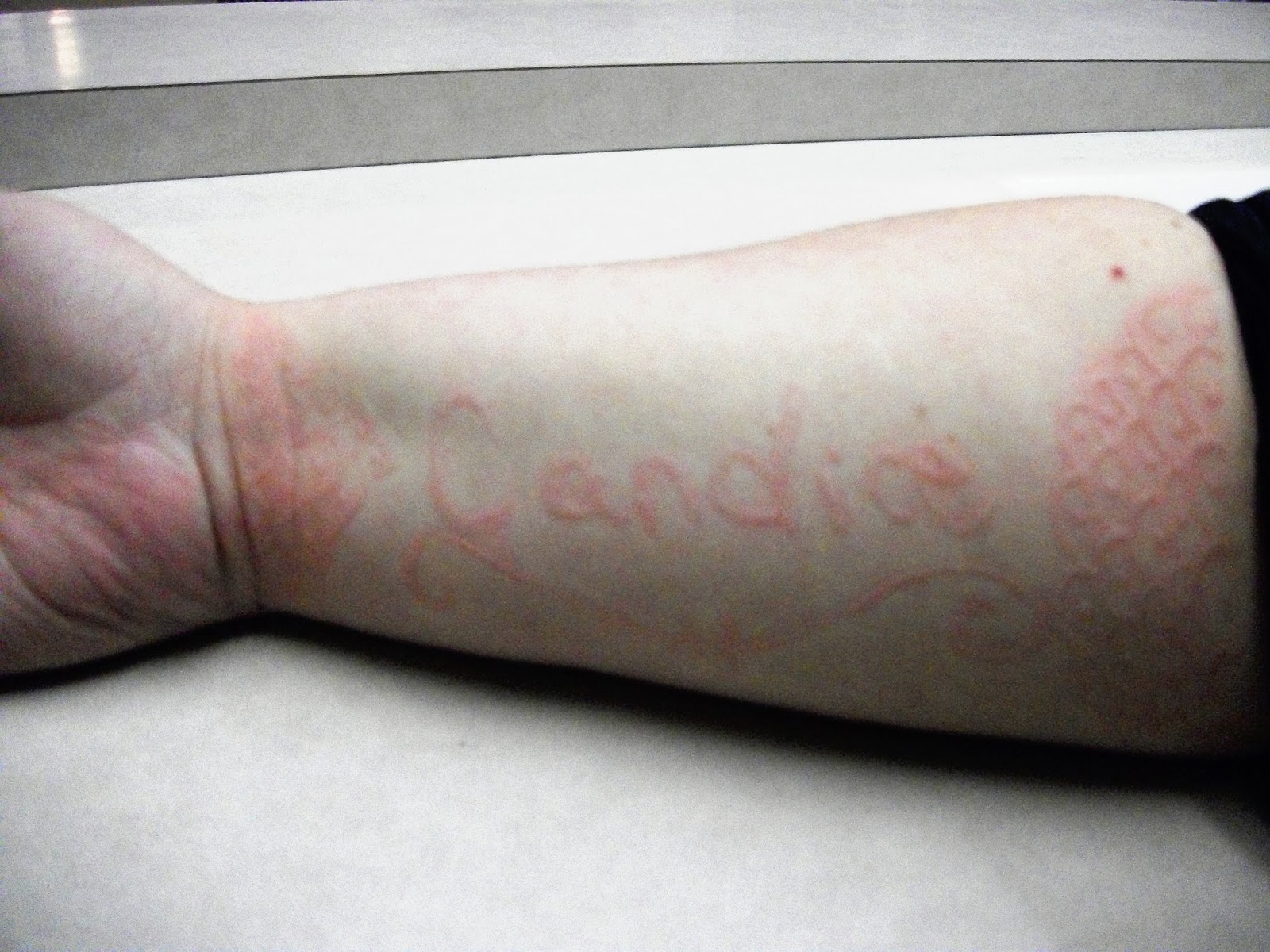 The Multi Mom: Dermographism (Chronic Urticaria)