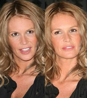 Elle Macpherson Plastic Surgery Before and After Botox and Breast ...