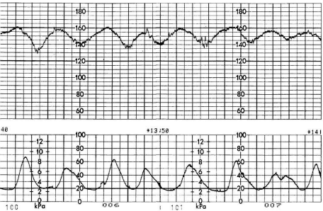 học Y: monitoring sản khoa (CTG