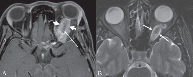 MRI Differential Diagnosis: Optic nerve enhancement