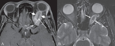 MRI Differential Diagnosis: Optic nerve enhancement