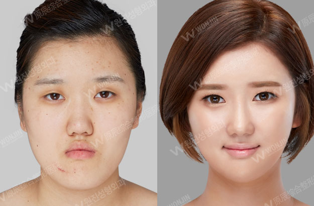 Different Types of Square Jaw Reduction Surgery for Different Face Shape