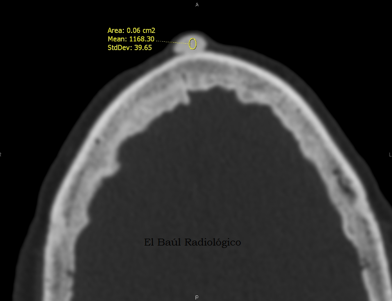 El Baúl Radiológico: OSTEOMAS CRANEALES. (Cranial Osteomas. CT Findings ...