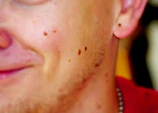 Photos of Moles on Face and Neck ~ How To Remove Moles, Warts, Skin ...