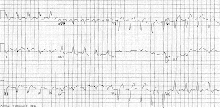ECG of the Week: ECG of the Week - 2nd November 2015 - Interpretation