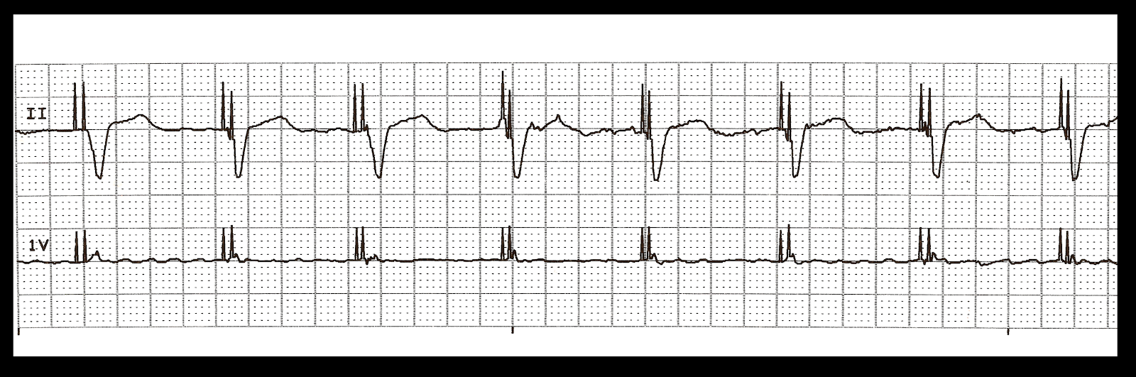 Various Biventricular Paced Rhythms