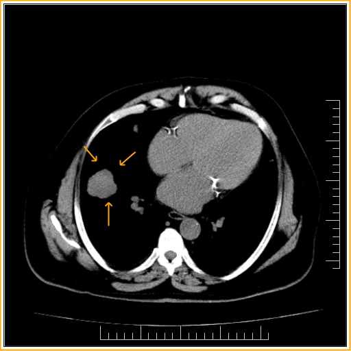 Solitary Pulmonary Nodule-CT - Sumer's Radiology Blog