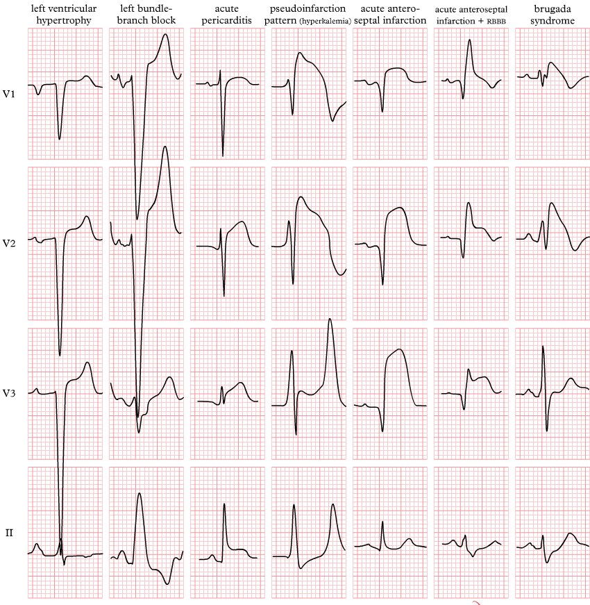 Morfologi Gelombang ST