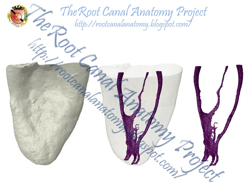 The Root Canal Anatomy Project: Middle Mesial Canal - Mandibular Molar