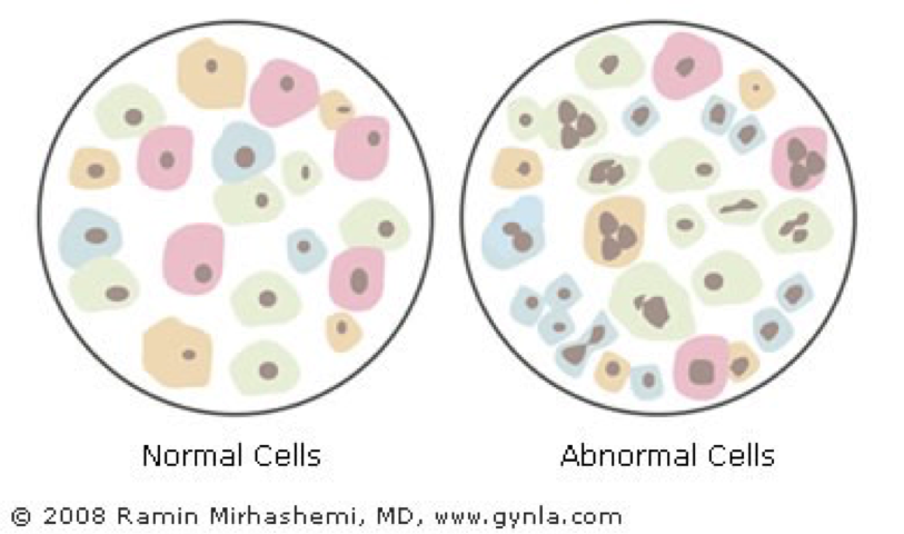 Abnormal Pap Smear information