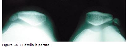 Un médecin du sport vous informe: fractures de la rotule