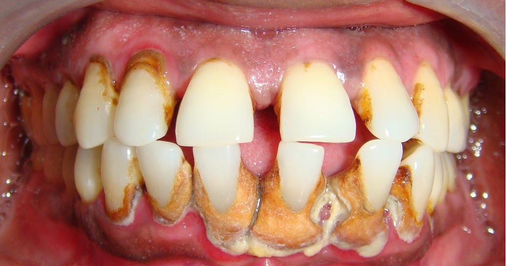 Dentistry lectures for MFDS/MJDF/NBDE/ORE: A NOTE ON DENTAL CALCULUS