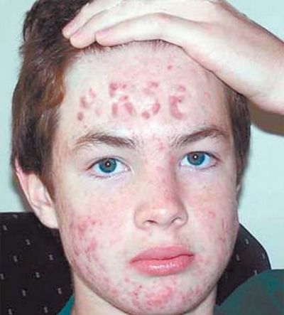 santos 4º ESO: clonado de cara con granos: