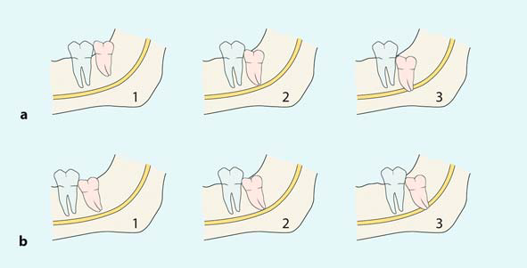 Dentistry and Medicine: Impacted Mandibular 3rd Molar Classification ...