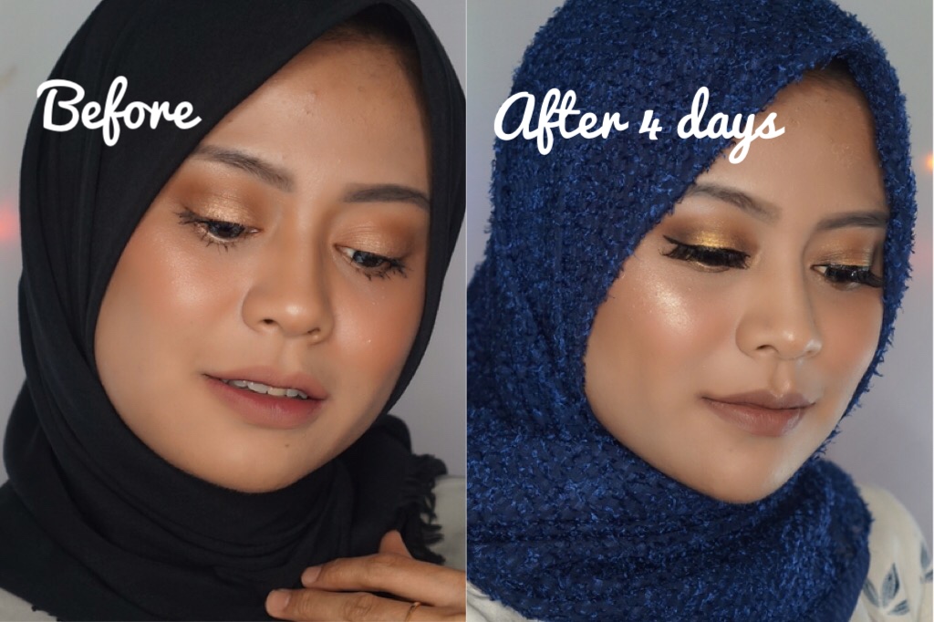 CARA MEMBUAT WAJAH JADI TIRUS DENGAN FILLER DAGU & BOTOX V SHAPE DI ...