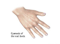 Cyanosis Causes, Symptoms and Treatment