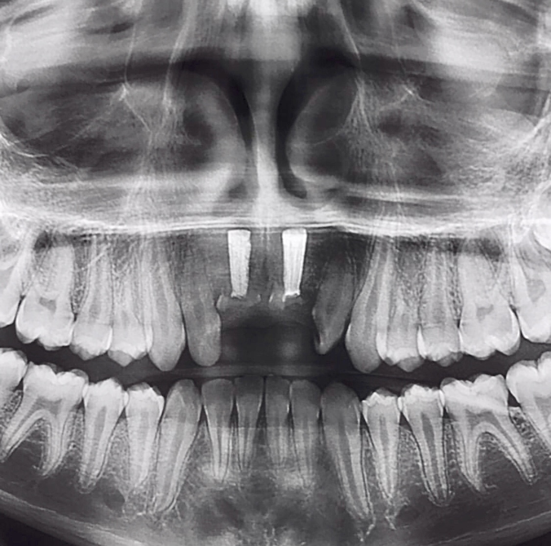 Complete root resorption after endo treatment in young permanent teeth ...