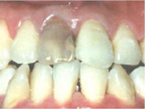 Ellis and Davey Classification - Endodontics and Oral Implantology