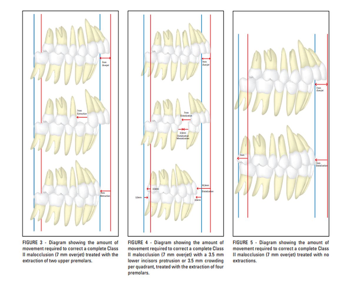 PDF: Relevant variables of Class II malocclusion treatment ...