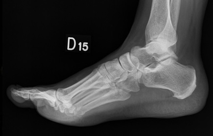 Radiología Silva2: Pie Lateral