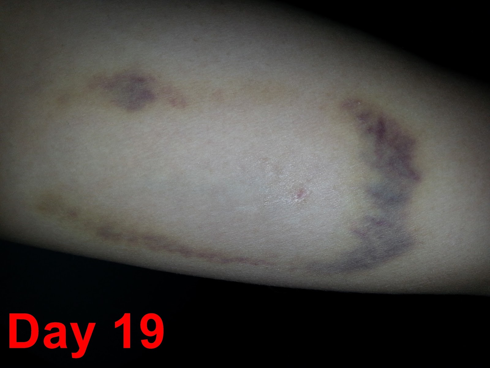 My experience with the birth control Implanon