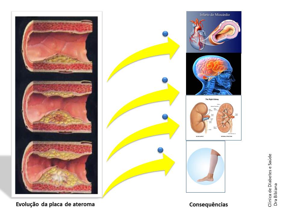 Dra Bibiana-Diabetes e Saúde: O que é o Colesterol e suas Frações?