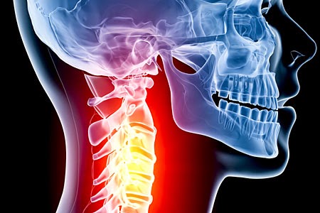 Diskus hernia: Diskus hernija vratni simptomi