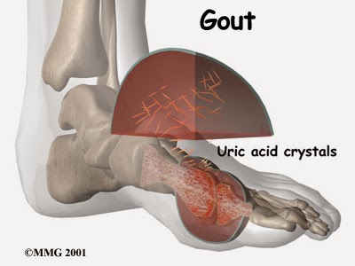 NewGen Advanced Orthotics Lab: Gout - Causes and Symptoms