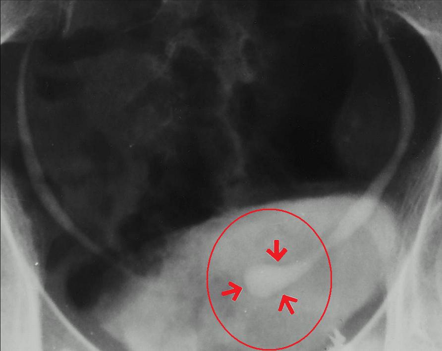 ABC Radiology Blog: Cobra Head Sign