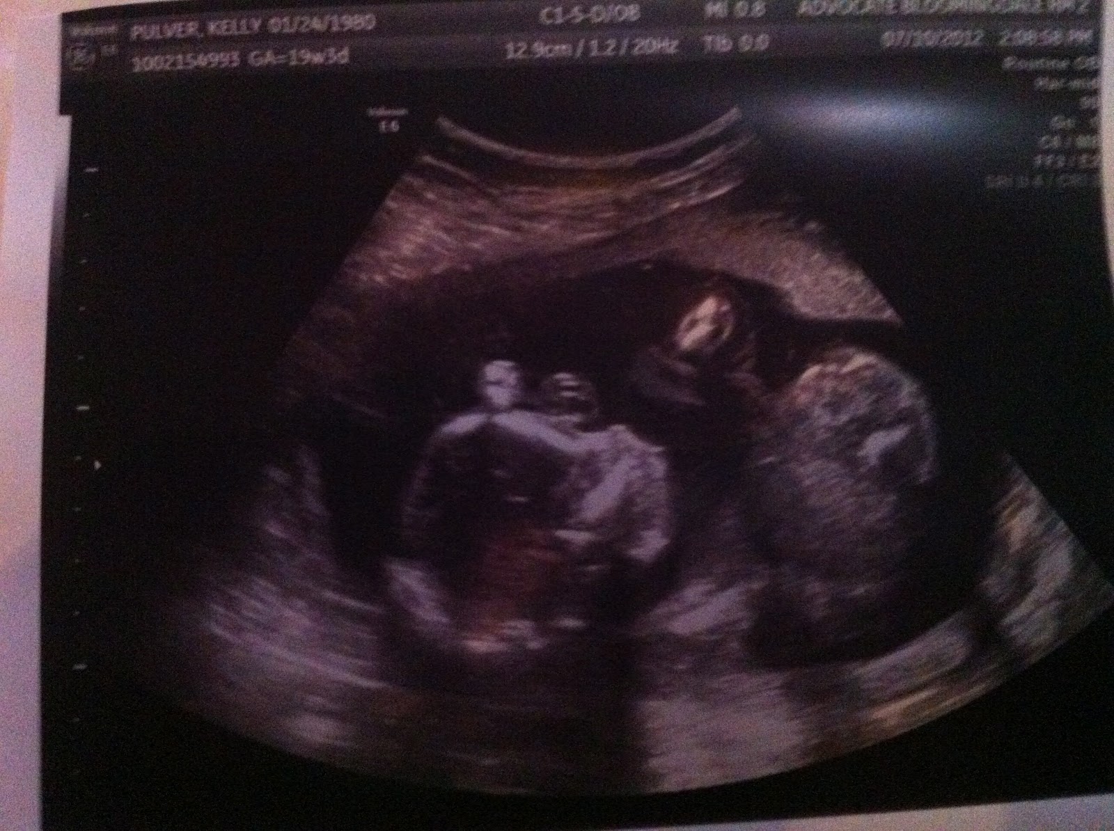 Baby Pulver!!!: 19 week Level 2 Ultrasound