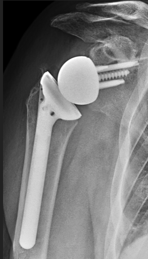 Shoulder Arthritis / Joint Replacement : Reverse total shoulder ...